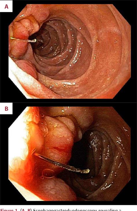 Figure 1 From Ivc Filter Perforation Through The Duodenum Found After