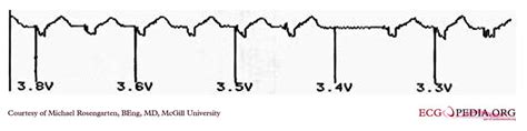 Artificial Pacemaker Wikidoc