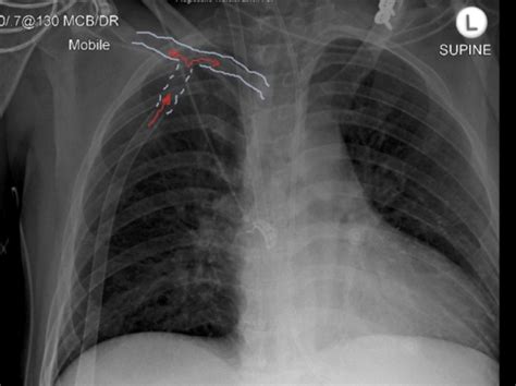 Everything ECMO Archives Page Of INTENSIVE