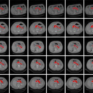 Visual Comparison Of CT Pancreas Segmentation Results Between Different