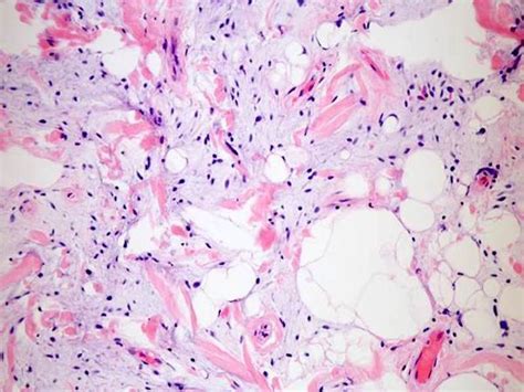 Pathology Outlines Spindle Cell Pleomorphic Lipoma