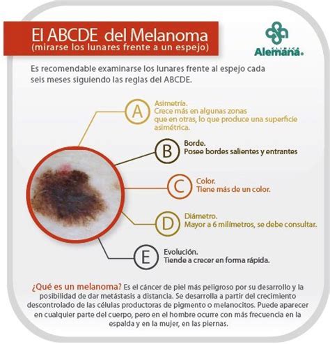 Abcde Del Melanoma Clínica Alemana De Santiago Enfermeriaaps