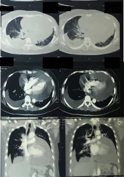 The Multislice Thorax Ct Scan Examination Showed Mixed Type Pulmonary Download Scientific