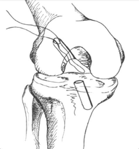 Standard Femoral Tibial Tunnel Download Scientific Diagram