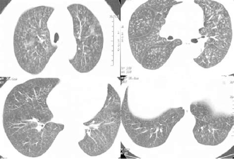 High Resolution Computed Tomography Scans Of Subacute Hypersensitivity Download Scientific