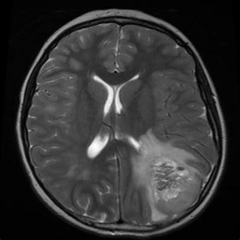 Tum Segmentation Object Detection Dataset By Projects