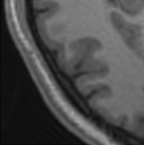 Github Yunzeman Dcsrn An Implementation Of Brain Mri Super Resolution Using D Deep Densely