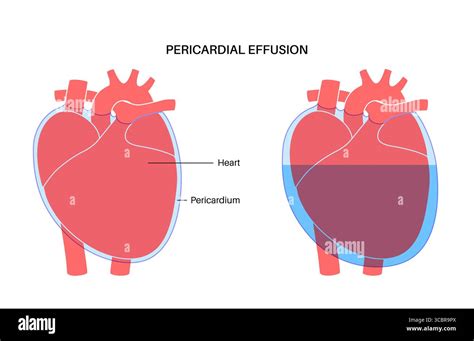 Illustration Of Pericardial Effusion The Heart This Is The Buildup Of