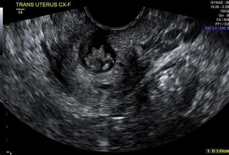 Radiopaedia Case Cervical Polyp Id Study Nc Commons