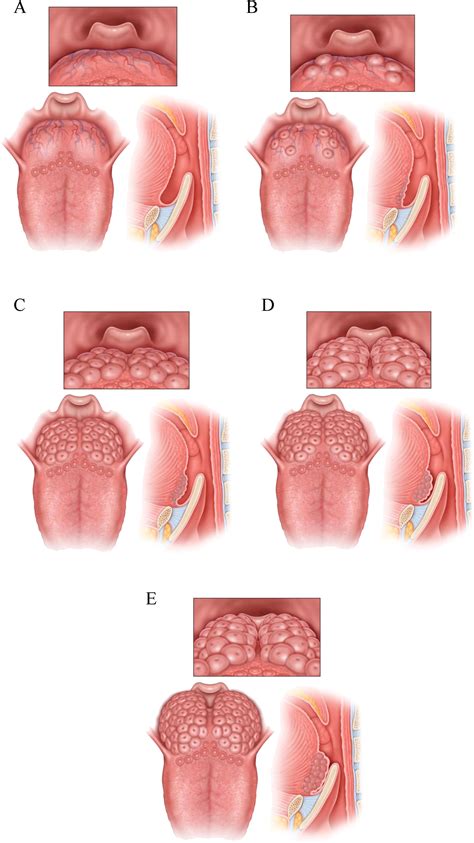 Evaluation Of The Patient With Obstructive Sleep Apnea Friedman Tongue Position And Staging