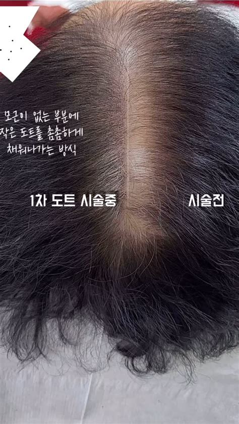 성신여대눈썹문신 남자눈썹문신 수유눈썹문신 성신여대속눈썹 반영구수강 반영구학원 혜화눈썹문신 🥇원장 이종민 원하는 부위 어디든지👌두피문신으로 자신감 𝐔𝐏 Ojoy Min