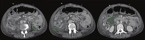 Medical Imaging Of Abdomen Noncontrast Computed Tomography Scan Showed Download Scientific