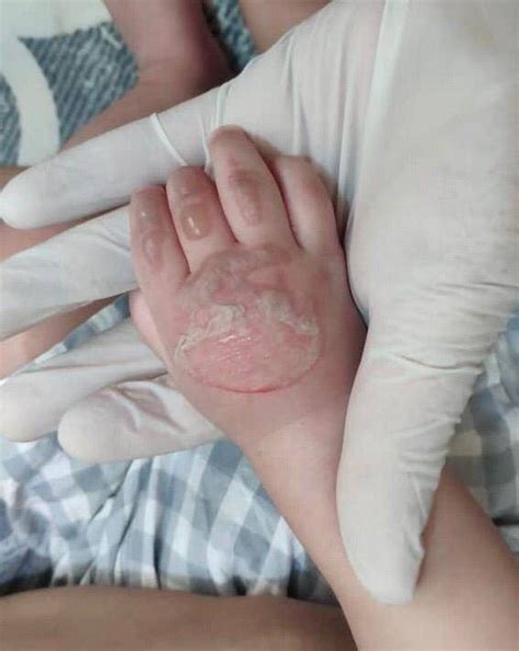 طبقه بندی سوختگی و درجه های آن عکس سوختگی کلینیک التیام