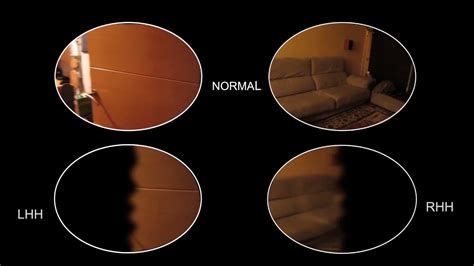 Hemianopia Rehabilitation With Ground In Sectorial Prisms Of Palomar