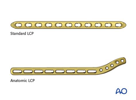 Orif Plate Fixation Distal 1 3 For Multifragmentary Fracture Intact Segment