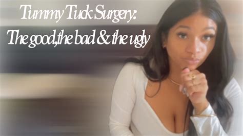 The Truth About Tummy Tuck Surgery Youtube