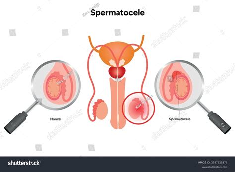 Spermatocele Testicular Disease Man Reproductive Health Stock Vector Royalty Free 2587525373