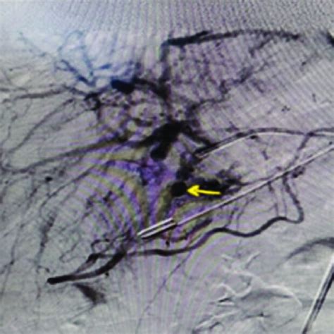 Computed Tomography Angiography Showing Pseudoaneurysm From The