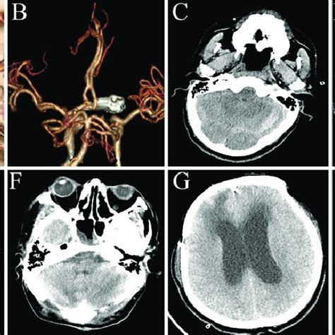 A Preoperative Computed Tomography Angiography Cta Examination