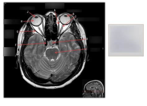 T2 Weighted Axial Transverse Brain Through Region Of Orbits Diagram