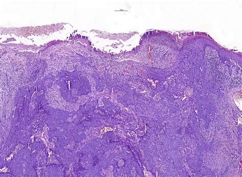 Basal Cell Carcinoma Histology