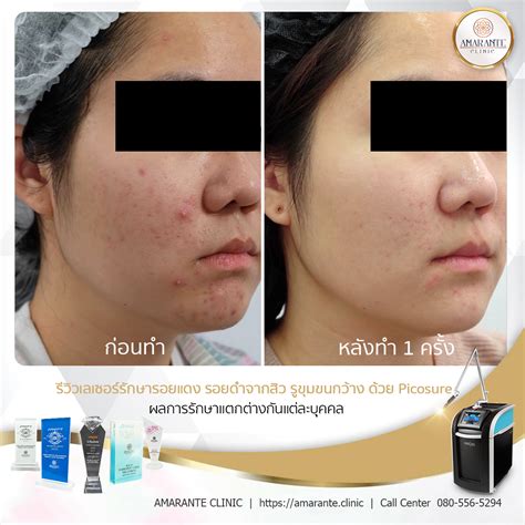 โปรแกรม Pico Laser มีกี่แบบ แต่ละยี่ห้อ แตกต่างกันอย่างไร