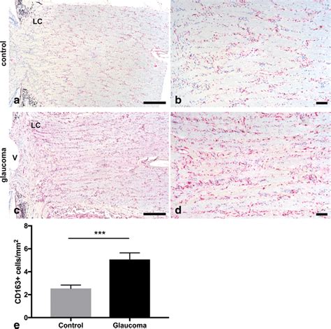 Glaucomatous Optic Nerves Contain More Cd163 Cells Compared To