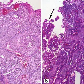 Pdf Significance Of Inverted Pattern In Non Invasive Low Grade