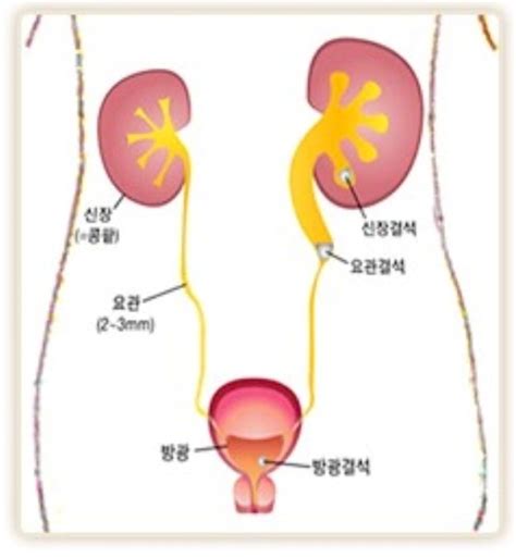 신장요로결석 증상 진단 칼슘원인 배출 재발 자연치유 유니시티코리아 유여림 네이버 블로그