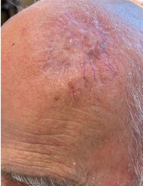Real Patient Case Cohn Plastic Surgery