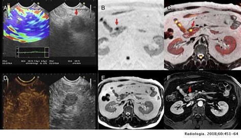 Functional Imaging In Pancreatic Disease Radiología English Edition