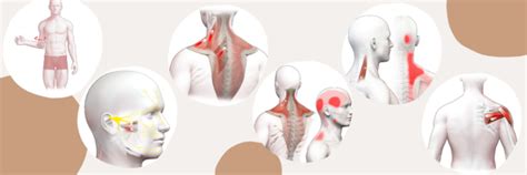 Levator Scapula Crick In The Neck Triggerpoint Coach