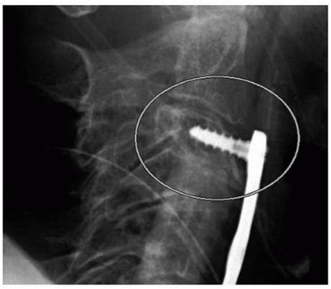 Cervical Vertebrectomy And Plating Musculoskeletal Key