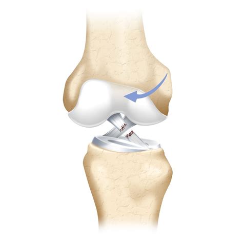 Hamstring Tendon Graft Reconstruction Of The Acl Physioflow Pt