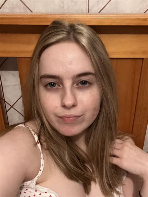My Accutane Results R Accutane