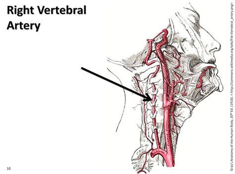 What Is Occlusion Of Right Vertebral Artery At Evelyn Hoff Blog