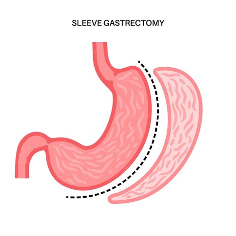 Premium Vector Vertical Sleeve Gastrectomy Laparoscopy Stomach