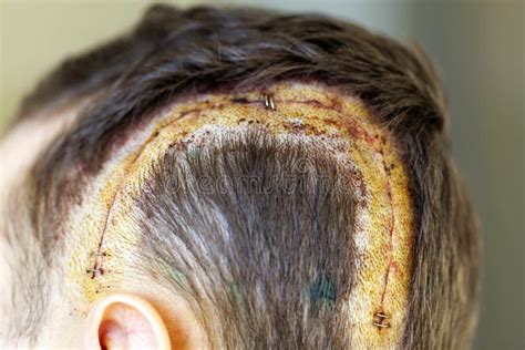 Visible Close Up Of Man Patient`s Suture Surgical Suture On The Head