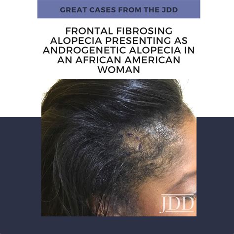 Frontal Fibrosing Alopecia Presenting As Androgenetic Alopecia In An