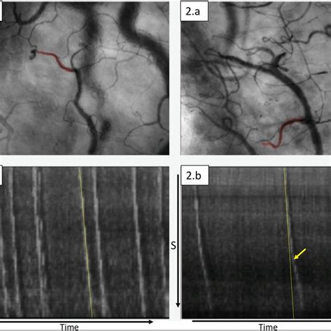 Sublingual Microcirculation Sublingual Microcirculatory Parameters At
