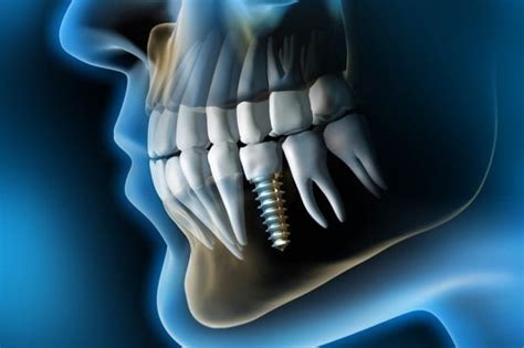 Cirugía guiada por ordenador Dentista Girona CESADEN Clínica