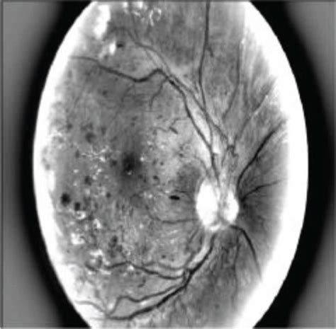 Proliferative Diabetic Retinopathy With Random Shifted Augmentation Download Scientific Diagram