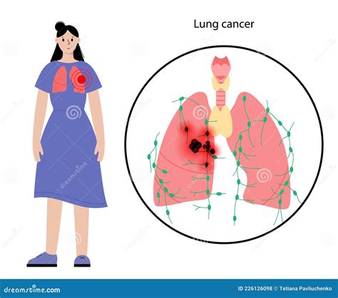 Cancro Ai Polmoni Illustrazione Vettoriale Illustrazione Di Anatomia