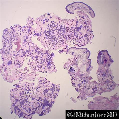 Primary Cutaneous Mucinous Carcinoma Jerad Gardner Md