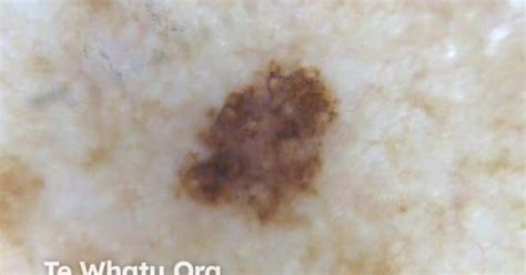 Superficial Spreading Melanoma Image