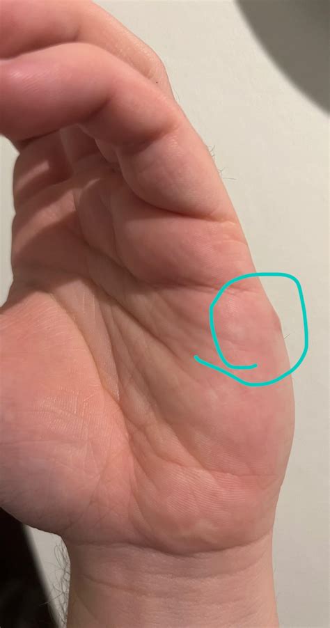 Scar From A V Lino Knife Rscars