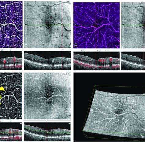 C Scan Image Of Optical Coherence Tomography Angiography Shows A Large