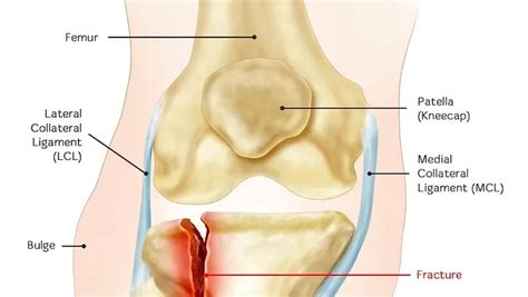 Proximal Tibia Anatomy