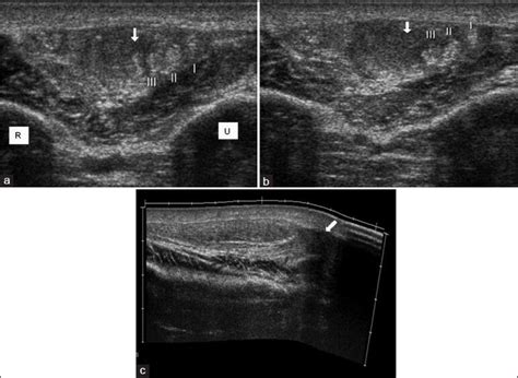 Ultrasound And Doppler Us In Evaluation Of Superficial Soft Tissue Lesions Journal Of Clinical