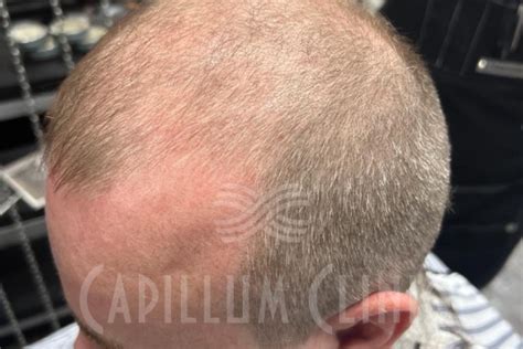 Лечение андрогенной алопеции у мужчины Capillum Clinic